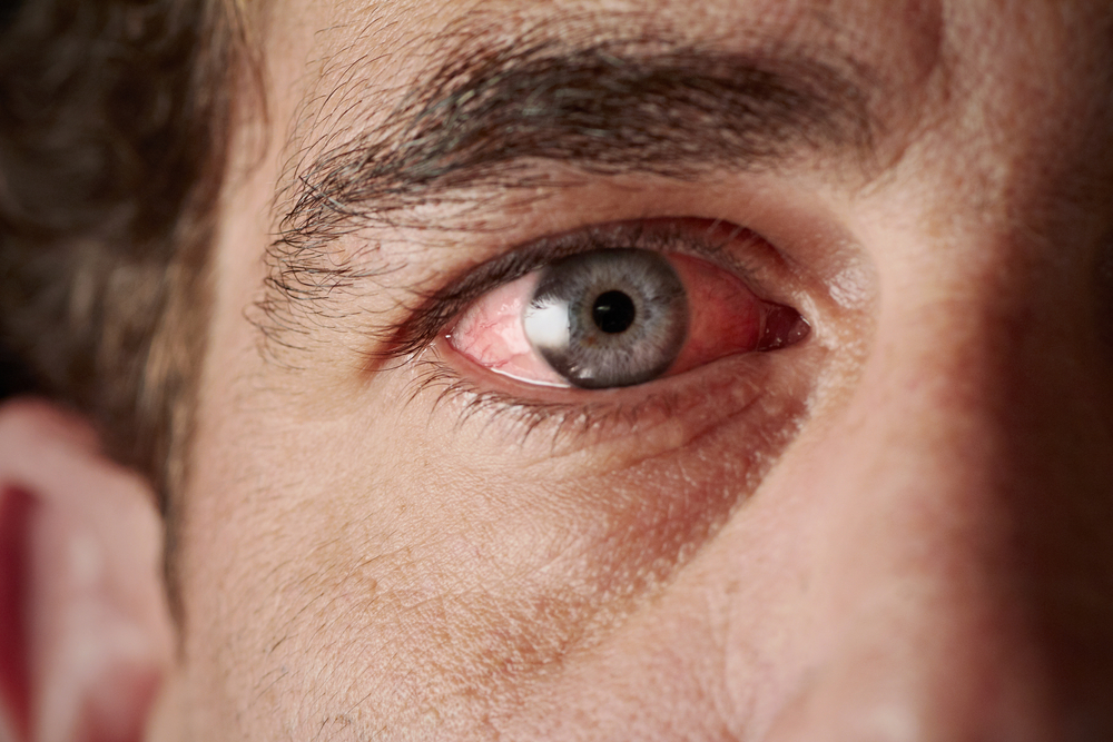 Conjunctivitis | Alamo Eye Institute